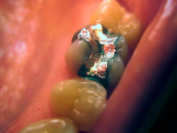 Dental Horrors The Bizarre Cases Of Exploding Teeth Historic Mysteries